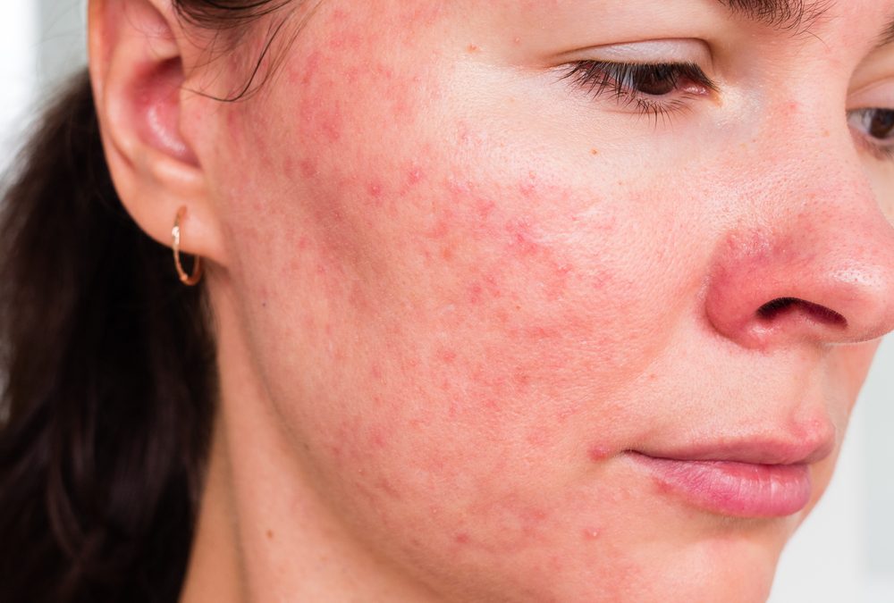 Rosacea – Symptoms & Treatments | Laser Aesthetics Vascular Therapists ...